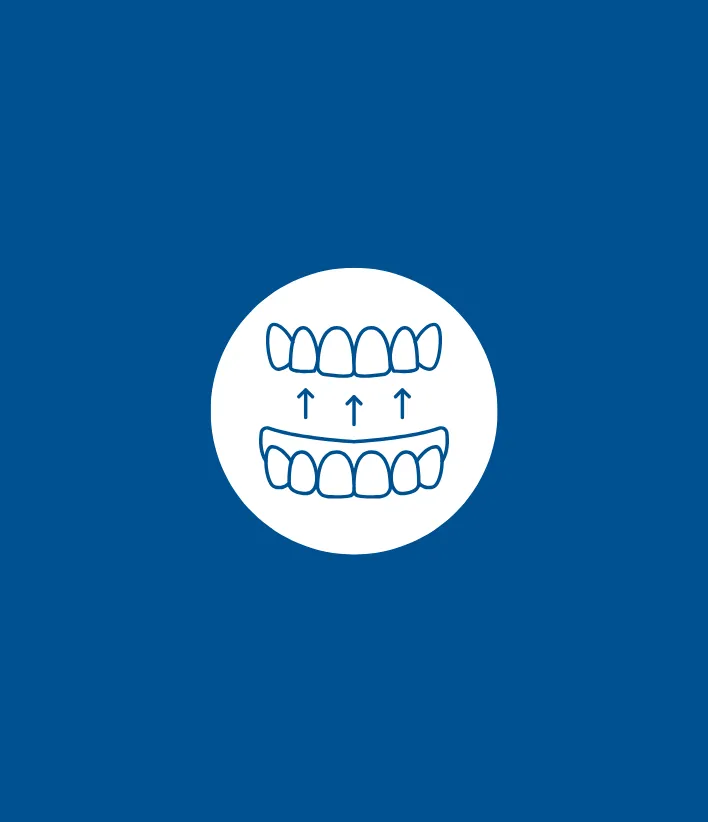 Full Arch Implantaire atelierdentaire.tn